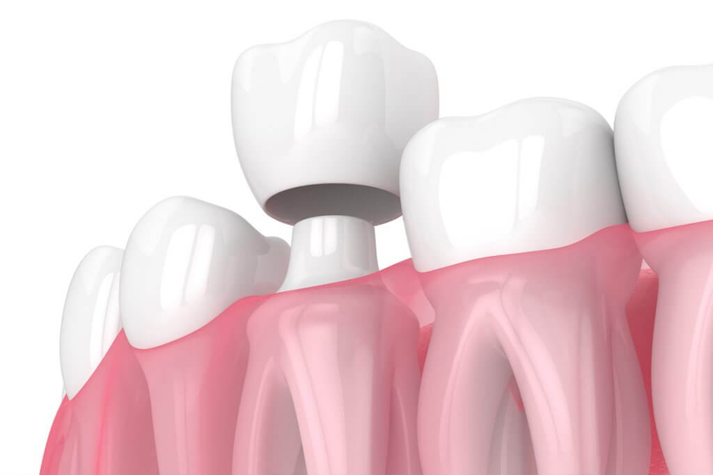 How Much Tooth Structure is Needed for a Crown?